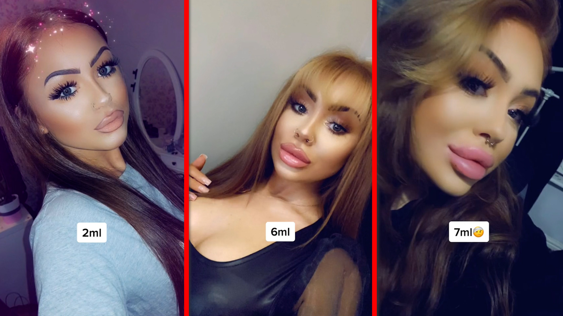 Ima 7 mililitara hijalurona u usnama i ne planira da stane: Svi joj ...